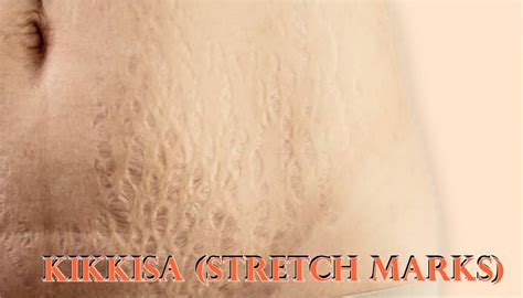 Striae Gravidarum