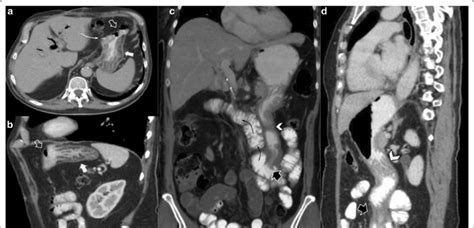 Gastrojejunostomy And Duodenojejunostomy A B Gastrojejunostomy Download Scientific Diagram