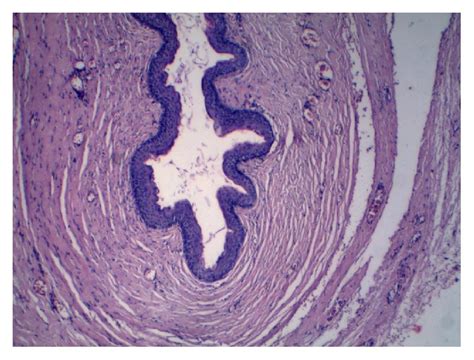 Vulvar Epidermoid Cyst And Type 2 Radical Genital Mutilation Pmc