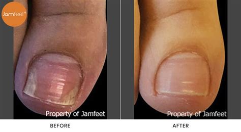 Before And After Toenail Surgery Photo Gallery