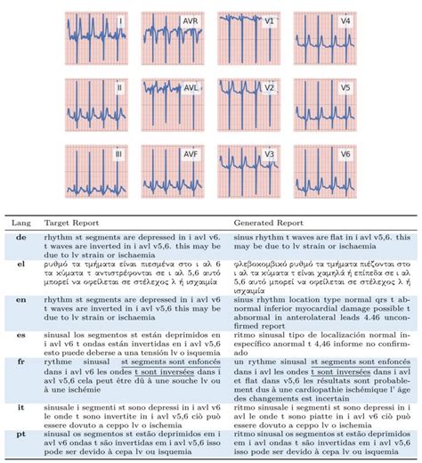 Dani Kiyasseh Dphil On Linkedin Captioning Deeplearning Ecg