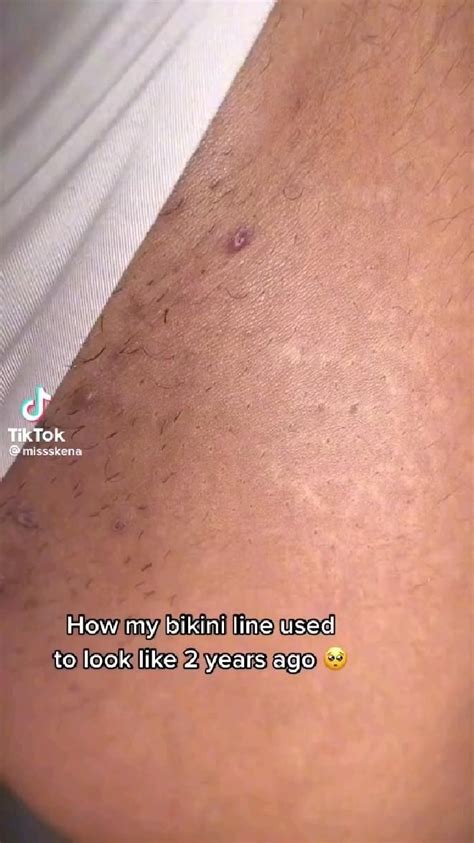 7 Ways To Get Rid Of Acne On The Buttocks Artofit