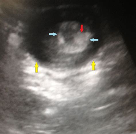 Us View The Proximal Segment Intussusceptum Yellow Arrows The