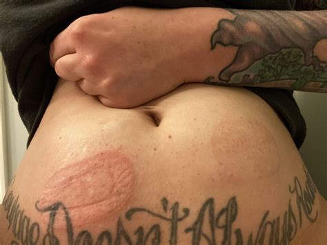 Did Dexcom Change Their Adhesive Formula Or Something Had A Dex For Years Now And Never Had