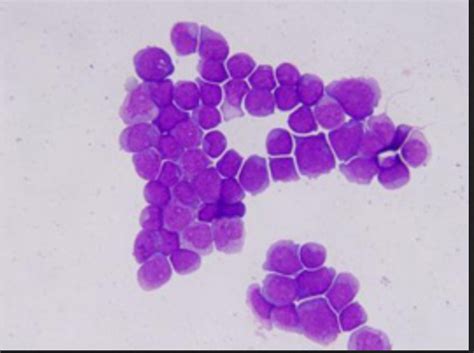 Leukemia Treatment Service In Kolkata Id 19507393991