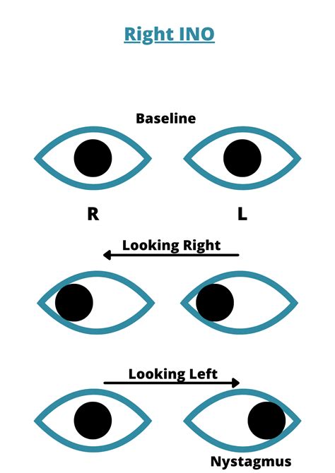 Gaze Abnormalities Prep Duke Elder