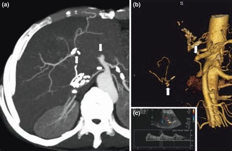 Ct Scan And The Three Dimensional Vascular Reconstruction Of Patient 1