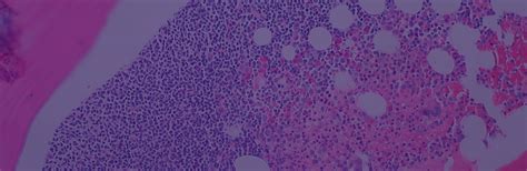 Lymphoma