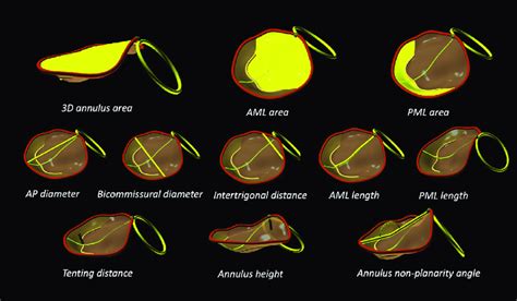 Comprehensive Semiautomatic Quantification Of Ma And Leaflet Geometry Download Scientific