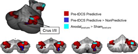 Anodal Tdcs Increased Activation In Right Crus Iii Of The Cerebellum Download Scientific
