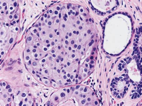 Ductal Carcinoma In Situ Clinical Tree