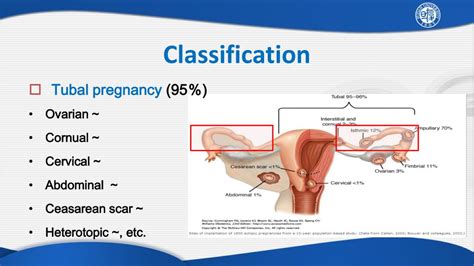 Ppt Ectopic Pregnancy Powerpoint Presentation Free Download Id 2176500