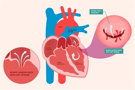 Sa Van 2 Lá Nguyên Nhân Triệu Chứng Chẩn đoán Và điều Trị