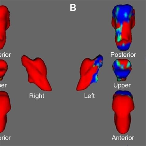 A Statistical Maps Corrected For Age Education And Sex Showing