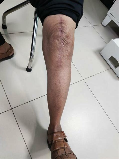 Appearance Of Knee Replacement Scar And Range Of Motion In A 87 Year