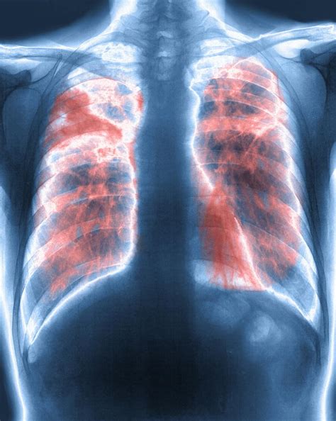 Fibrosis Of The Lung X Ray 1 By Science Photo Library
