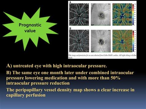 Prognostic Value Of Multiple Differential Diagnosis Of Onh By Oct Angio Pptx