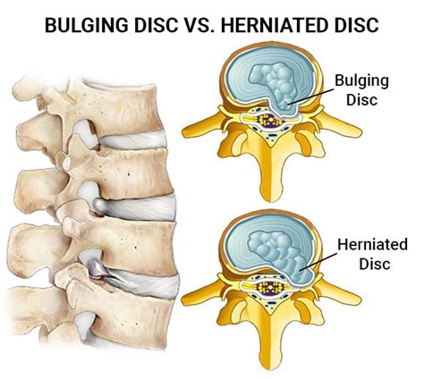 Dedicated Proficient Bulging Disc Doctor Near Linden NJ
