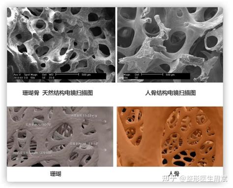 整形医生周斌：珊瑚骨填充是什么材料？珊瑚骨四大优势解析 知乎