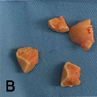 Different Fracture Patterns Considered For This Study Three Fragment Download Scientific