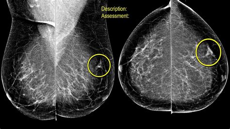 spot compression mammogram and ultrasound compre choices