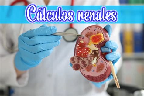 Cálculos Renales Clinica Hispana Mangum