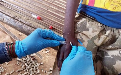 La Oms Declara Emergencia Sanitaria Internacional Por Brote Del Virus