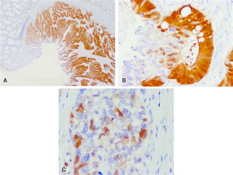 P16 Protein Detected By Immunohistochemistry A The Non Neoplastic Download Scientific