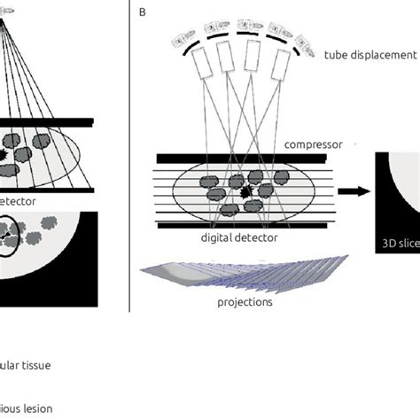 Schematic Acquisition Of Mammographic Images During Breast Compression