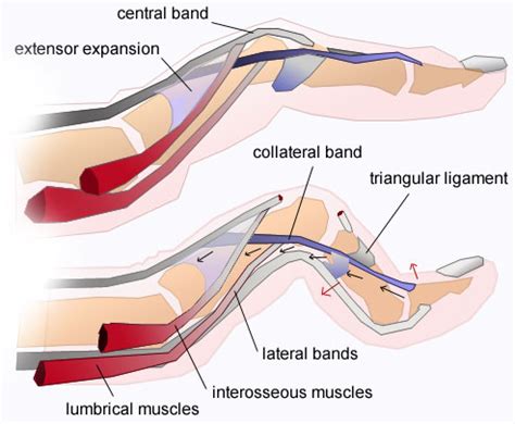 Boutonniere Deformity Hand Orthobullets