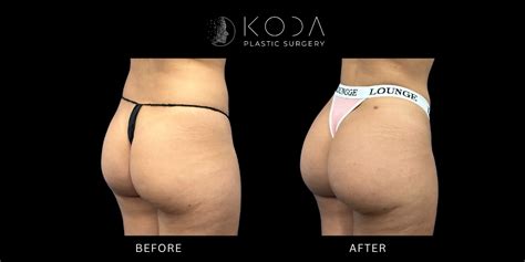 Skinny Bbl In Scottsdale Az Natural Butt Lift Results
