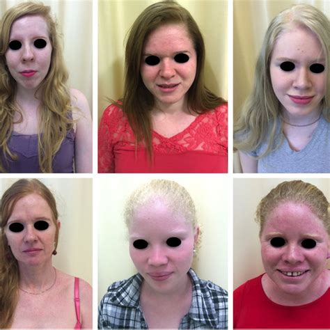 Phenotype In Albinism Wide Phenotype Variability Among Men With
