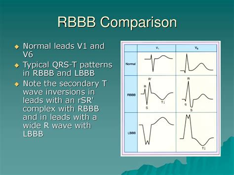 Practical Electrocardiography Bundle Branch Block Ppt Download
