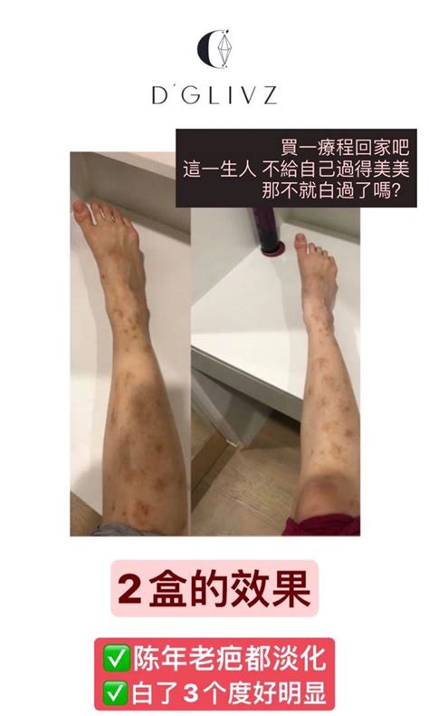 Snowbebe Skin Whitening Product Health And Nutrition Health Supplements Vitamins And Supplements