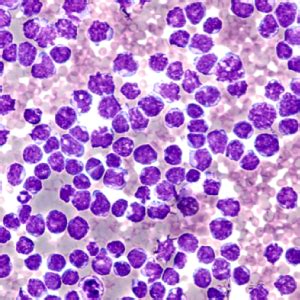 TRIANGLE Trial Results Support First-Line Ibrutinib Use in MCL