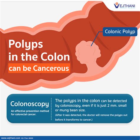 What Are Colon Polyps Colon Polyps Causes Symptoms And Treatment