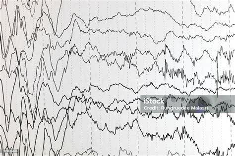 Brain Wave Patterns On Electroencephalogram Eeg Of The Pediatric