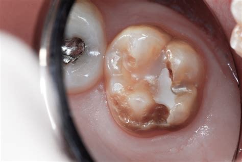 Enamel Hypocalcification Vs Enamel Hypoplasia