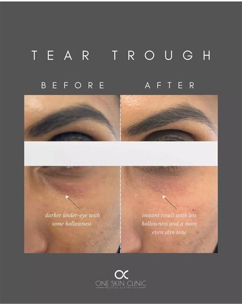 Dermal Fillers Harley Street Skin Treatment Harley Street Cosmetic