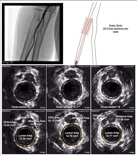 Figure 1 From Evaluation Of Radial Artery Atherosclerosis By