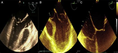 Carpentier Classification A Normal Motion B Excessive Motion C Download Scientific