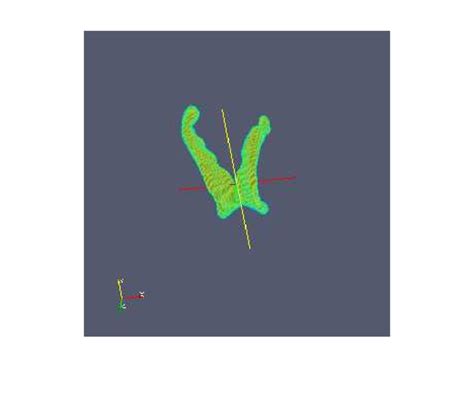 The Result Of Segmentation Of The Ventricles Using Geodesic Active Download Scientific Diagram