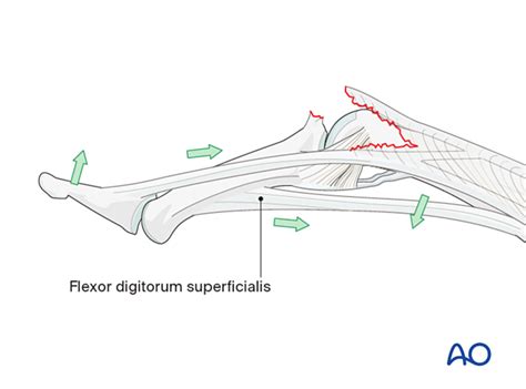 Dislocation And Fracture Dislocation Of The Proximal Interphalangeal Joint