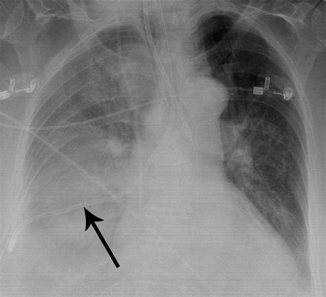 Catastrophic Complication Of An Electromagnetic Placed Postpyloric