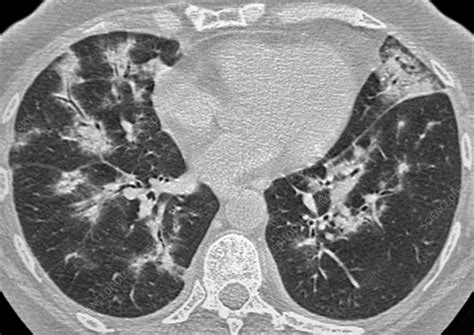 Diffuse Interstitial Pneumonia Lung Ct Scan Stock Image C038 4546