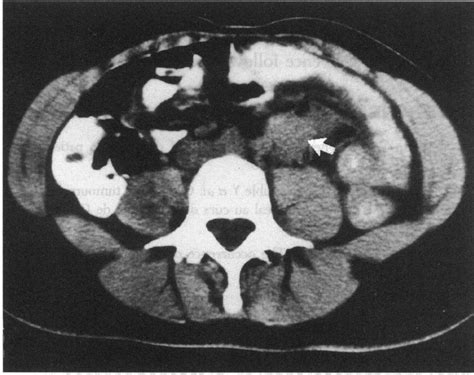 Computerized Tomography Appearance Of Mesenteric Desmoid Download