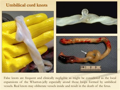 Triple Knot In Umbilical Cord At Susan Mcdaniel Blog