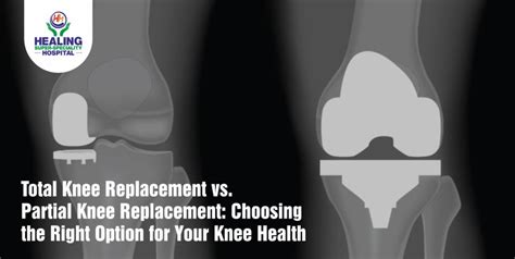Total Knee Replacement Vs Partial Knee Replacement Choosing The Right