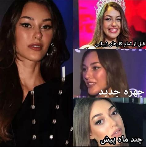 تغییر چهره دیلان چیچک دنیز از چشم خبرنگاران دور نماند