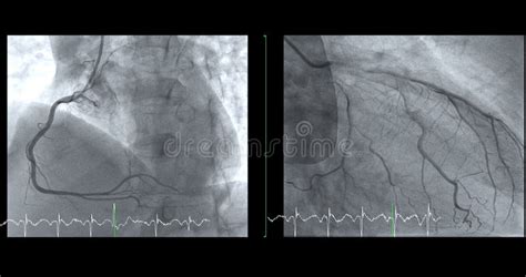 Cardiac Catheterization On Rca And Lad Can Help Doctor Diagnose And